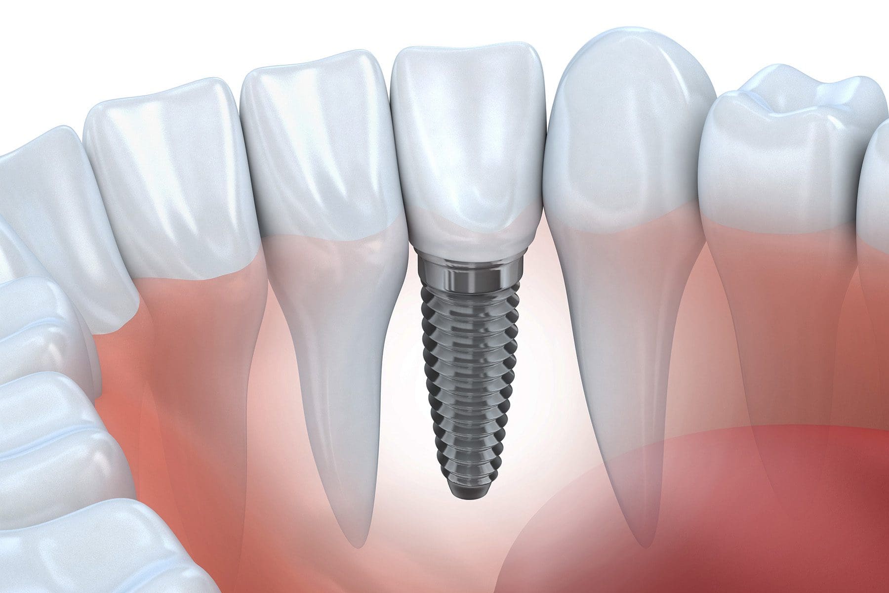 Dental Implants in Dudley | Restore Your Smile